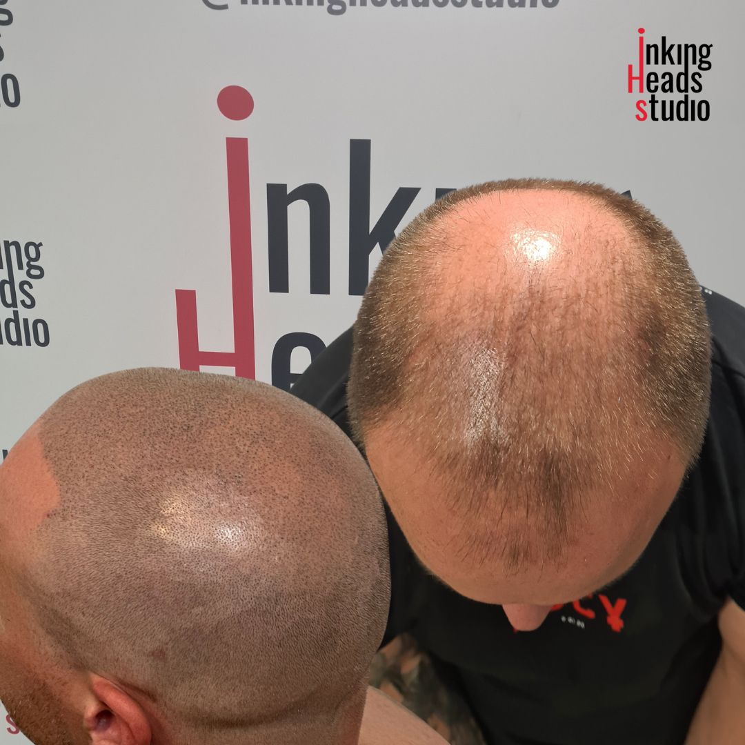 Scalp Micropigmentation | SMP | Inking Heads Studio